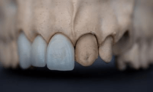 The Potential of USAG-1 Antibody Therapy for Tooth Regeneration – The ...